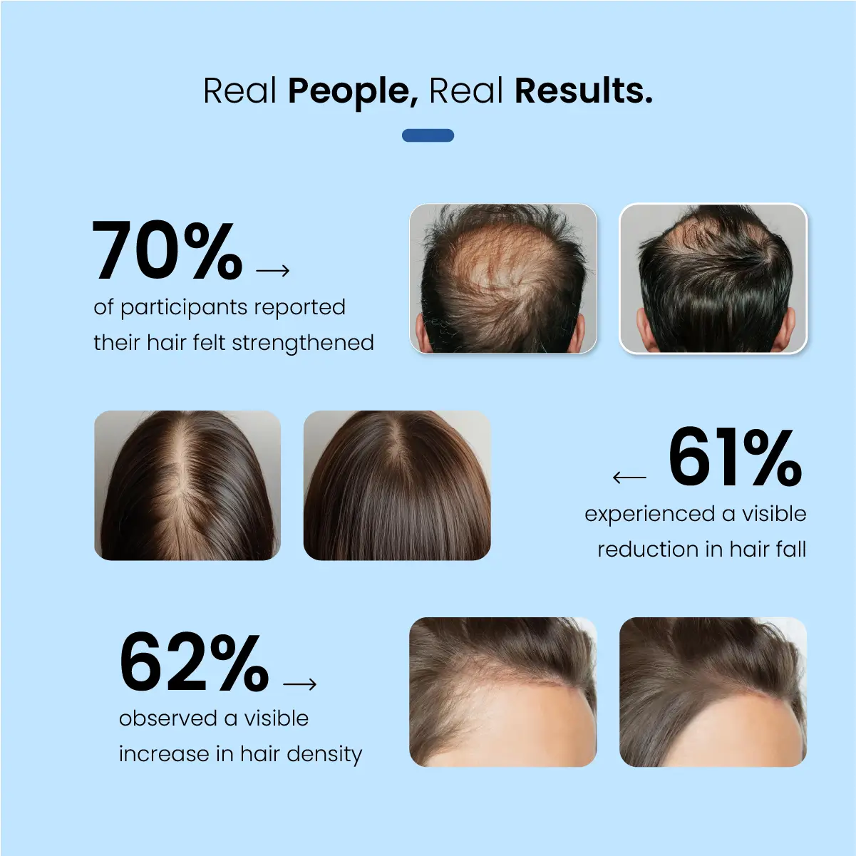 Minoxil F 5% Solution - Price, Uses, Benefits